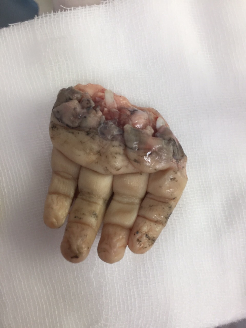 Ca hay tháng 09-10/2019: Cứu sống bàn tay bị dây sên xe hon đa nghiến ...