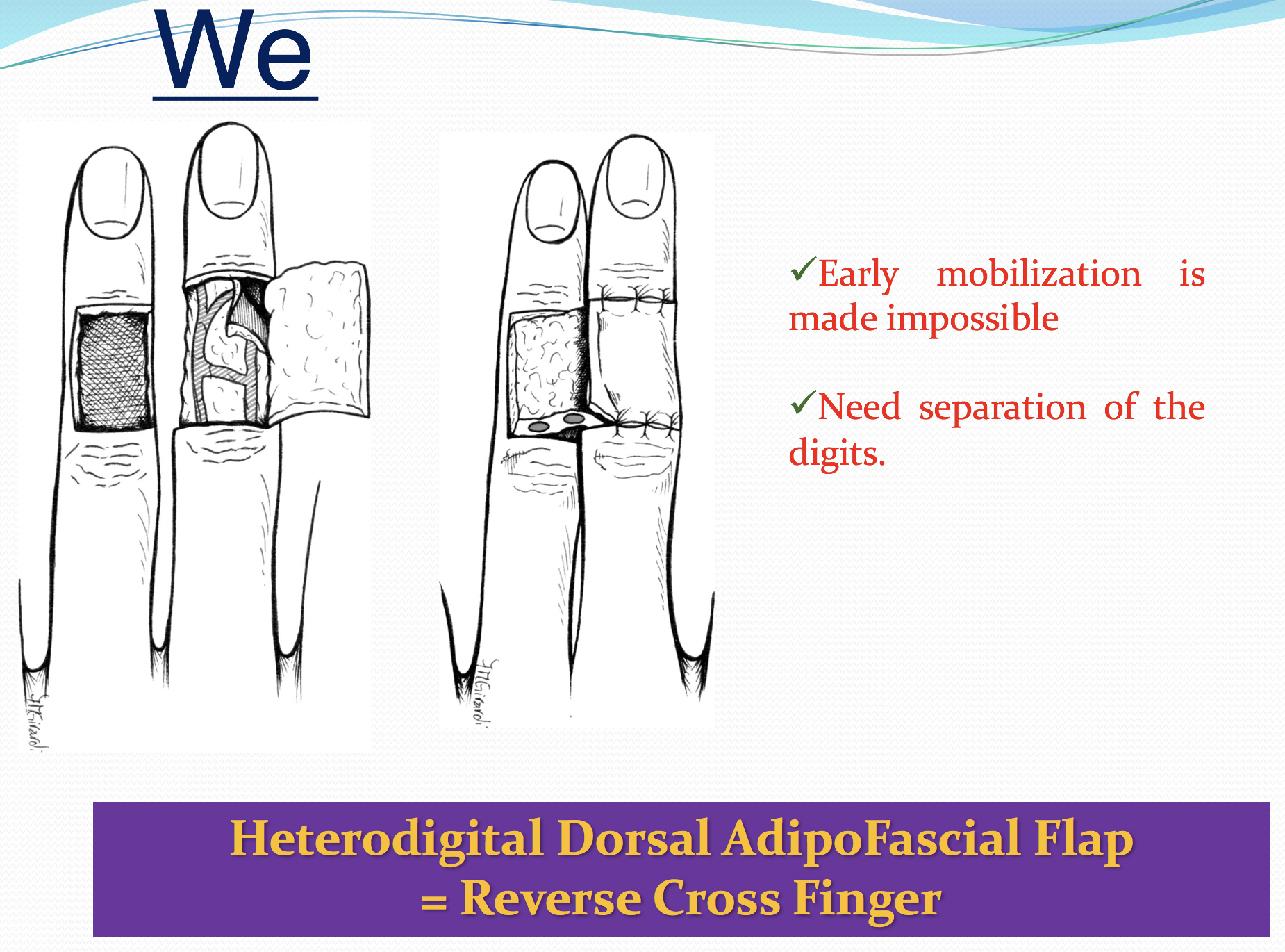 Homodigital Dorsal Adipofascial turnover flap