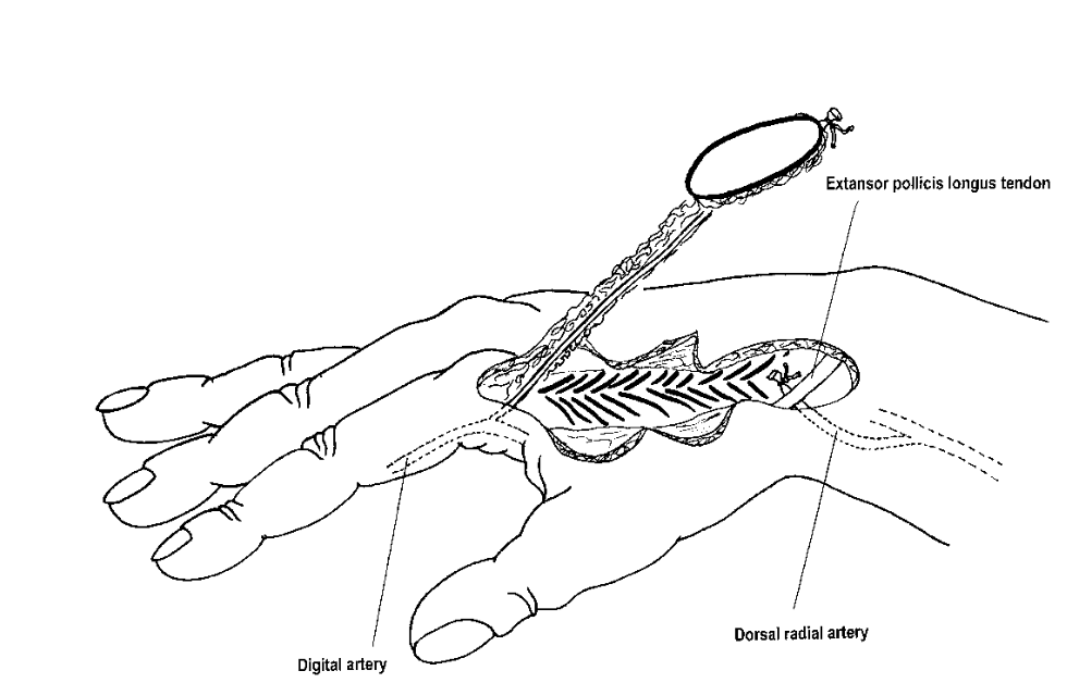 Reverse-Flow First Dorsal Metacarpal Artery Flap for Index Fingertip ...