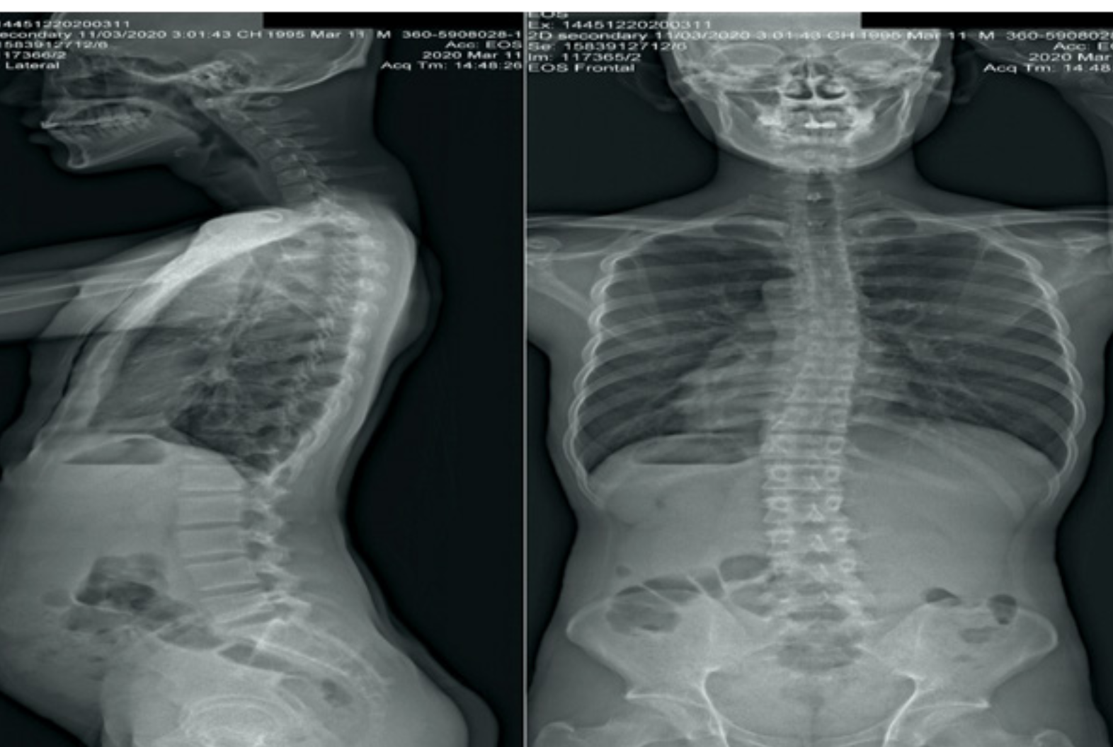 Surgical treatment of dropped head syndrome secondary to ...